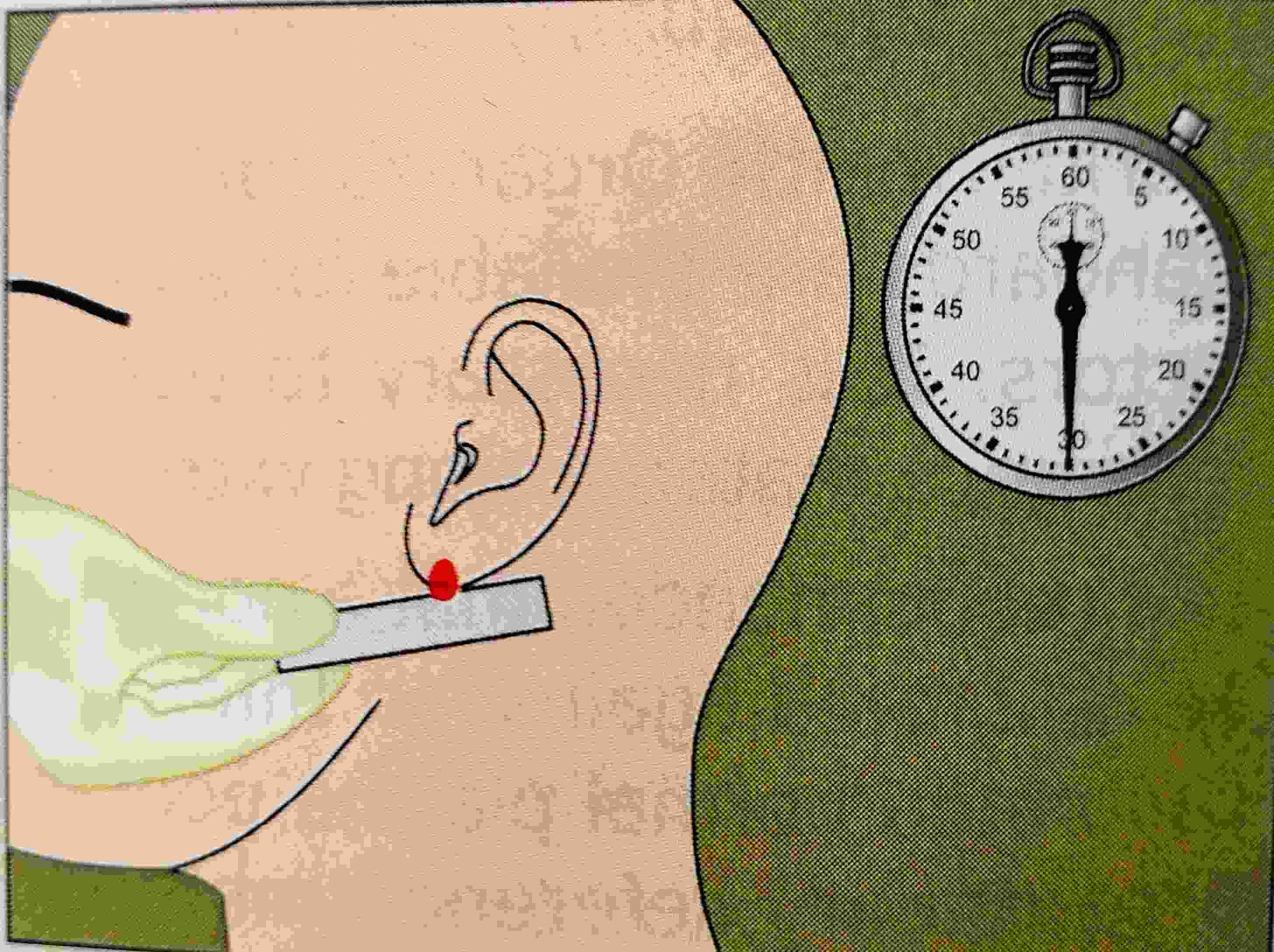 Bleeding Time Test Requirement,principle And Procedure